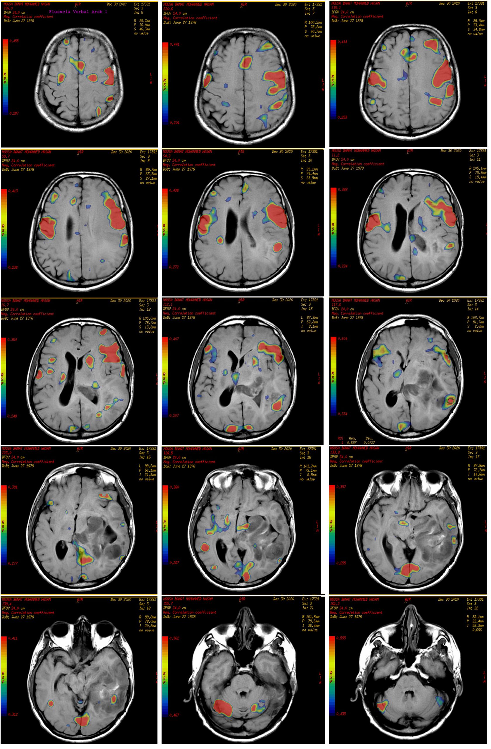 The Surgery in Spain – Brain Resection